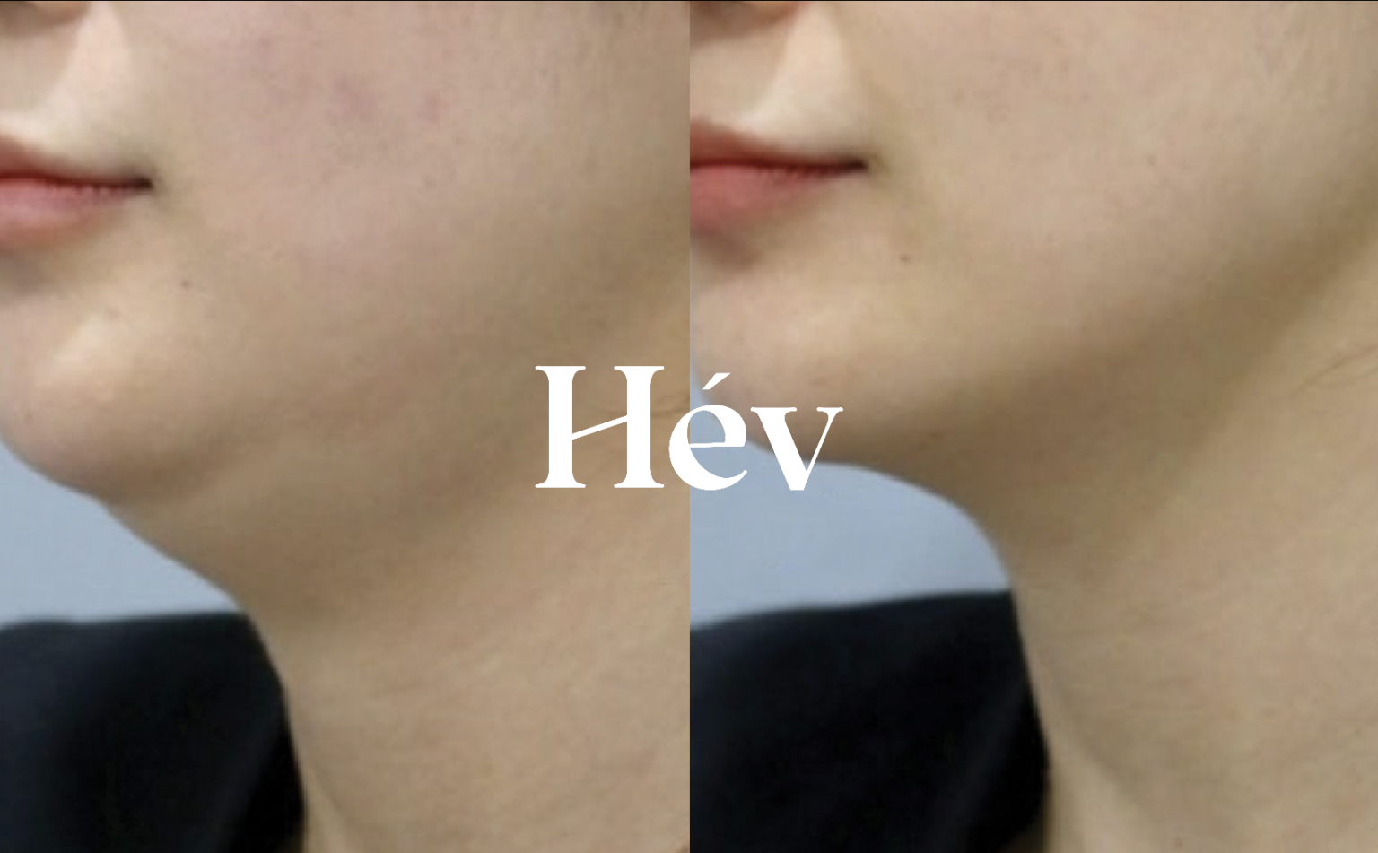 Double Chin Contouring in Korea - Ultherapy 300Shot + V-OLET Fat ...